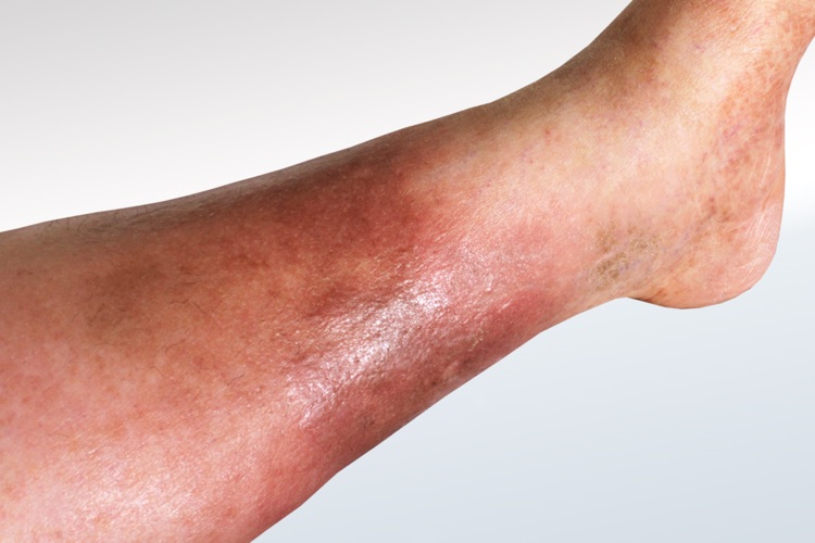 Cellulitis: Causes, Symptoms, and Treatments