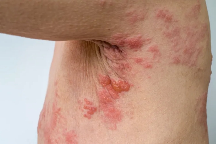 Shingles: Causes, Types, and Treatments