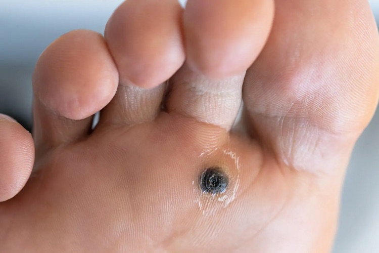 Warts: Causes, Types, and Treatments