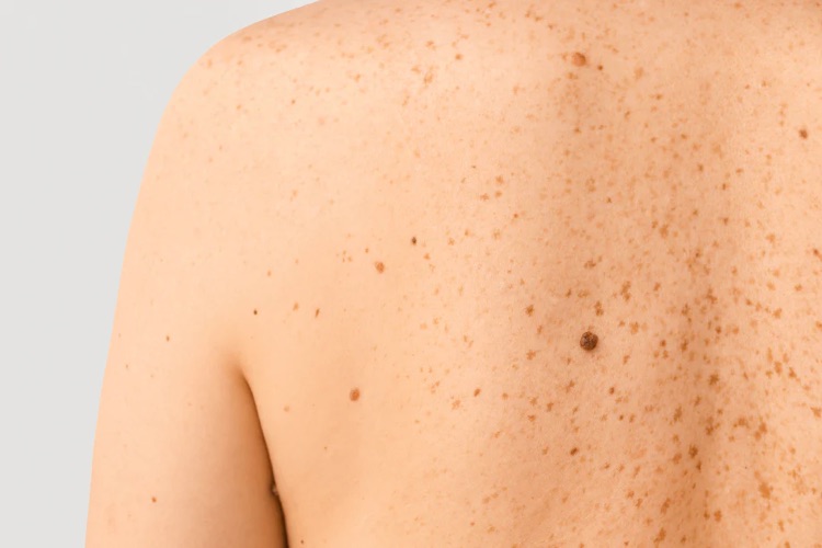 Skin Cancer: Causes, Types, and Treatments