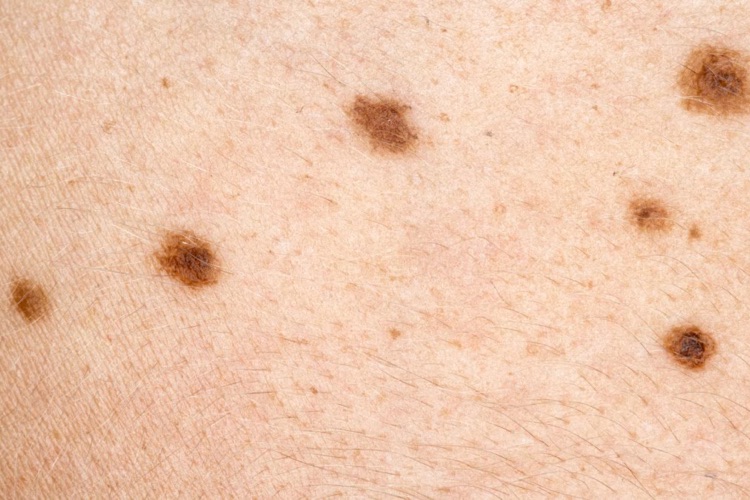 Skin Cancer: Causes, Types, and Treatments