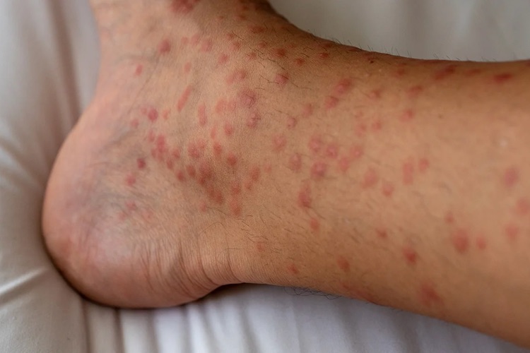 Hives: Causes, Symptoms, and Treatments