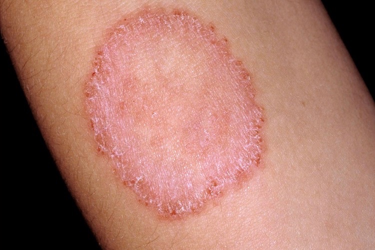 Ringworm: Causes, Types, and Treatments
